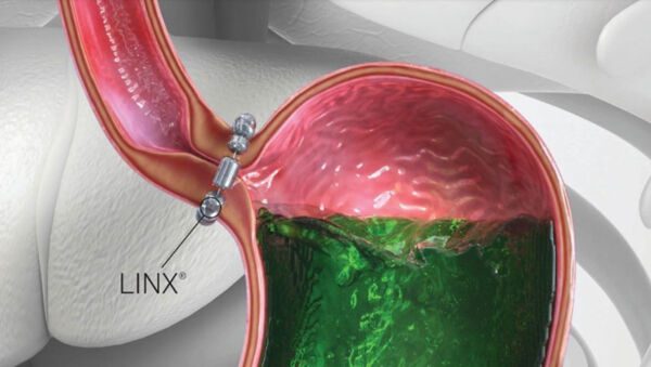 GERD Surgery, LINX & Hiatal Hernia Repair | Capital Surgeons